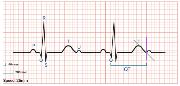 QT Interval: What Every Clinician Should Know - Fullagonist